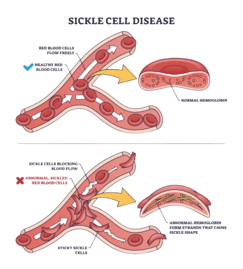 sickle cell anemia hemoglobin shape